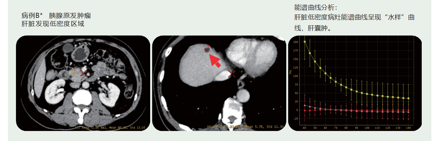 GE Revolution CT - 设备展示 - 贵黔国际医院
